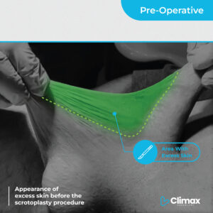 Scrotoplasty Surgery - Climax Andrology